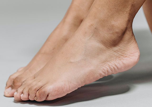 Einlagen nach Maß bei Knickfuß | MASTERSOLES