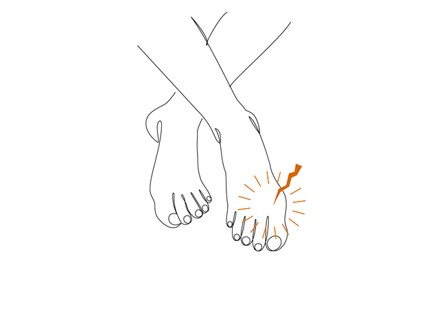 Einlagen nach Maß bei Hallux valgus | MASTERSOLES